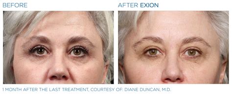 Exion Face In Greeneville Tn — Wholesome Rejuvenation Med Spa