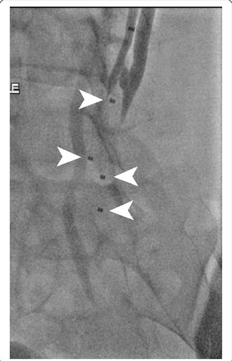 Final Case Image Showing Acute Occlusion Of The Vessels With Two Download Scientific Diagram