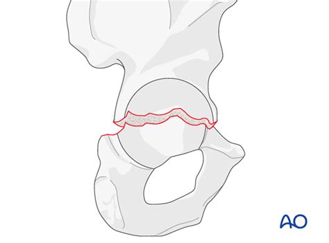 Pelvic Discontinuity