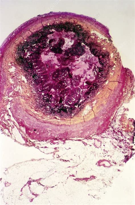 Appendicitis Light Micrograph Stock Image C021 2841 Science Photo Library