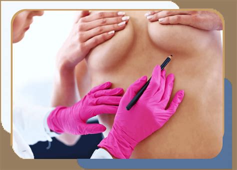 Prophylactic Mastectomy With Immediate Reconstruction Benefits Harris Prophylactic Mastectomy With Immediate Reconstruction Benefits Harris