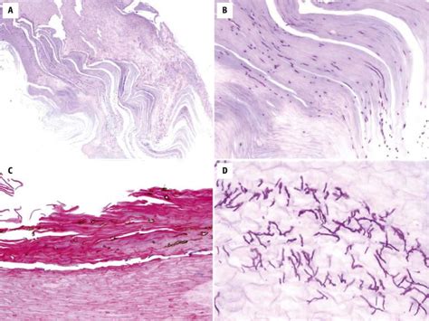 Neoplastic And Non Neoplastic Disorders Of The Nail Apparatus