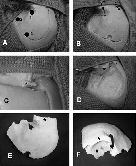 Modified Orbitozygomatic Craniotomy For Large Medial Sphenoid Wing