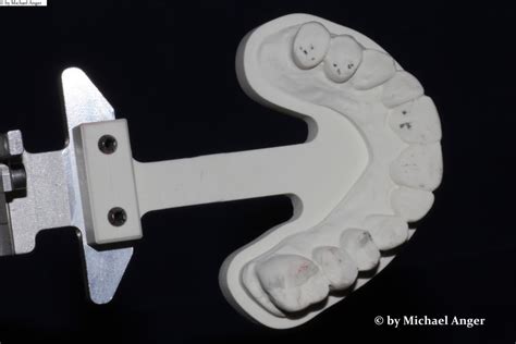 Itero Modelle Itero Models Dentalligent Blog