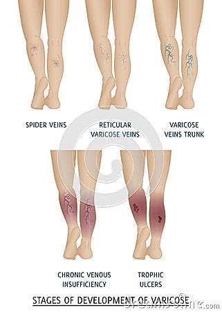 Types Of Varicose Veins In Women Stages Of Development Of Varicose Veins Vector Illustration