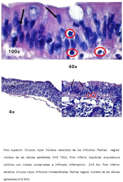 Colitis Linfocitica Histodiagnostico