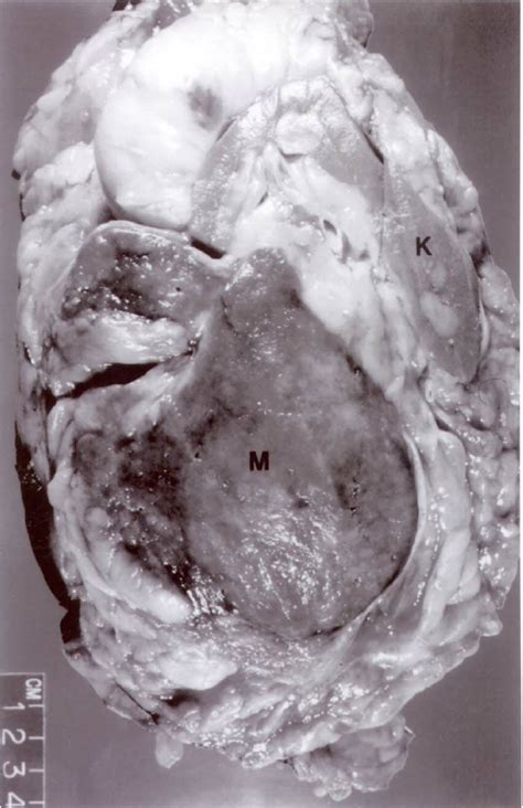 A Gross Photograph Of Left Radical Nephrectomy Specimen Showing A