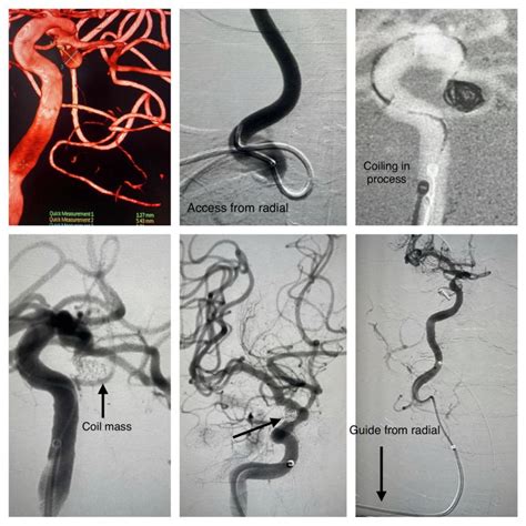 Kalyan Sajja On Linkedin 63 Year Old Woman Coming With Ruptured Pcom Aneurysm And Grade 2 Sah…