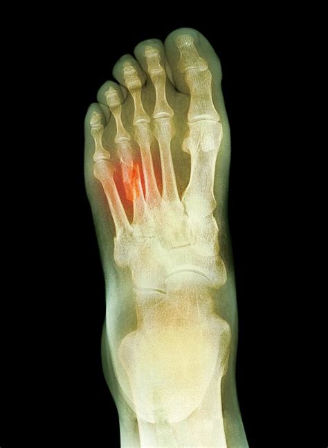 X Ray Broken Toe Toe Fracture Radiology Case