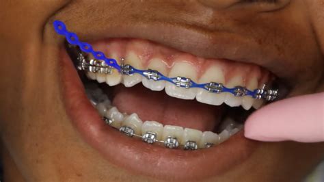 Watch BEFORE Getting POWER CHAIN on your braces.. - YouTube