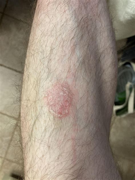 Pcp Thinks Psoriasis Via Biopsy Steroid Cream No Longer Works