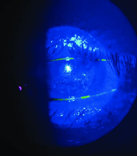 Punctate Epithelial Erosions Treatment