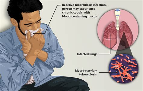 Long Term Effects Of Tuberculosis The Tube