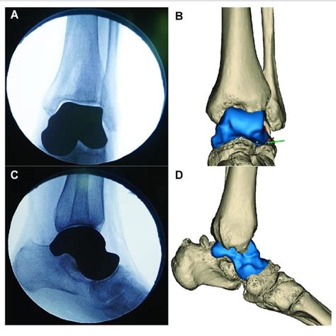 Pdf Total Talar Replacement With Custom Made Vitallium Prosthesis For Talar Avascular Necrosis