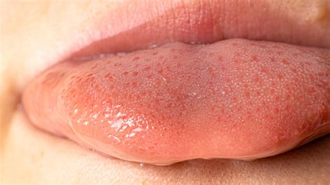 Fungal Infection Of Lips