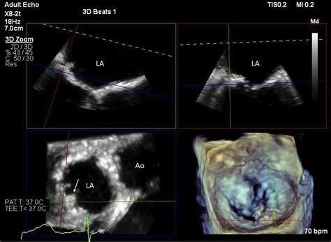 More Than A Simple Vegetation The Trifecta Of Mitral Valve Leaflet