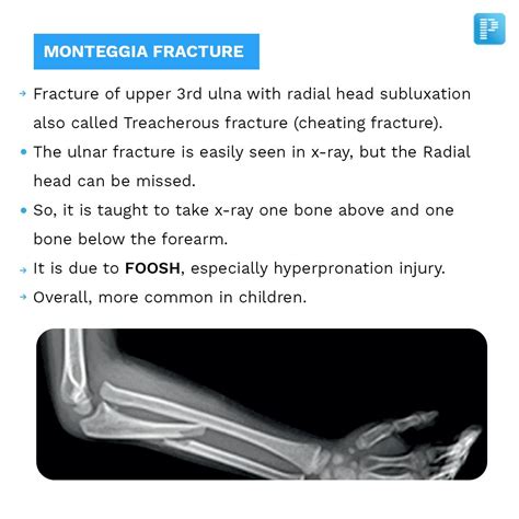 Monteggia Fracture
