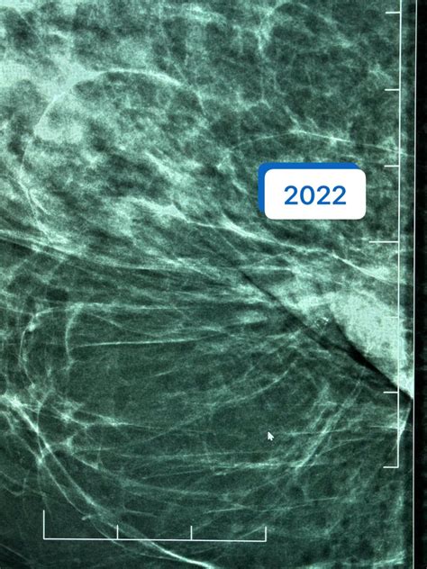 This Patient In 2022 Had Evidence Of Grouped Pleomorphic Calcifications… Dr Aaqib Javid