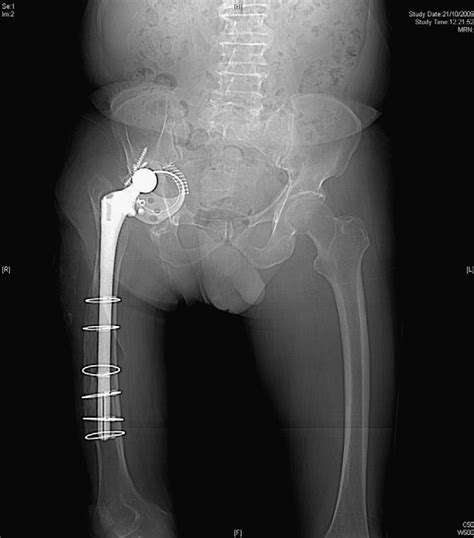 Radiograph Showing The Acetabulum Osteolysis And Protrusion Of The Download Scientific Diagram