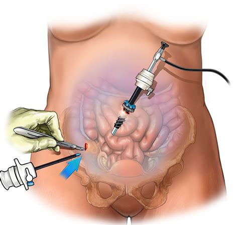 Endometriosis Laparoscopy Incisions Laparotomy Surgery For