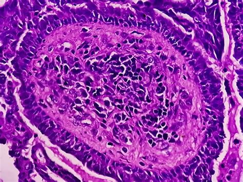 Durvalumab Approved For Endometrial Cancer Research Aacr