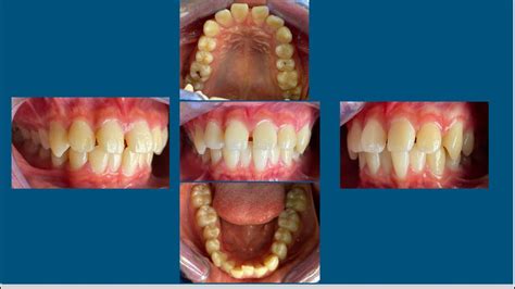 How To Treat Class 2 Occlusion Case Youtube
