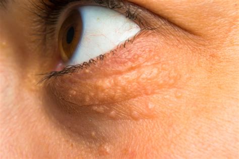 Xantelasma Causas Xantelasma O Que é E Como Tratar Clínica Dra