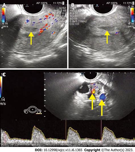 Transvaginal Ultrasonographic Examination Of The Uterine Cavity And
