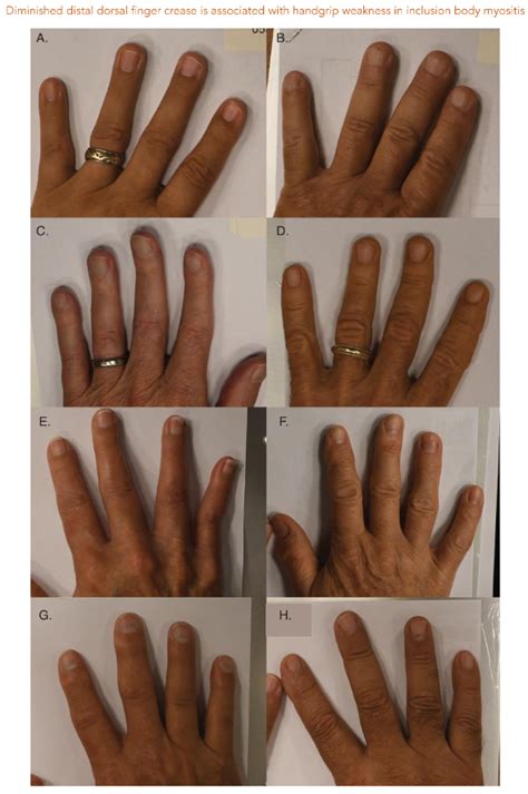 Diminished Dorsal Finger Creases In Myositis Patients European Society Of Medicine