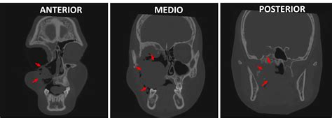 Neoplasia Maligna Evaluada Con Tomografía Maxilofacial Dento Metric