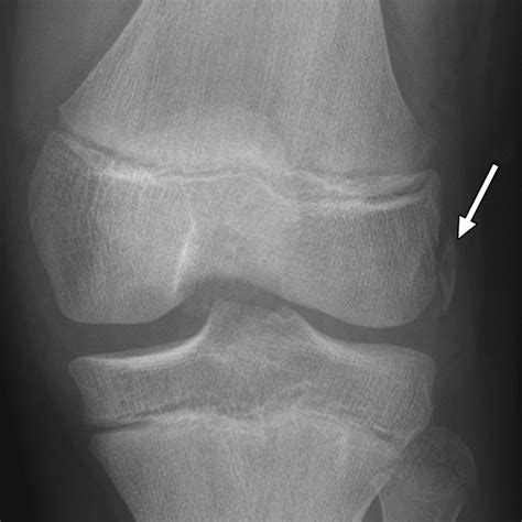 Mri Of Pediatric Patients Part 2 Normal Variants And Abnormalities Of