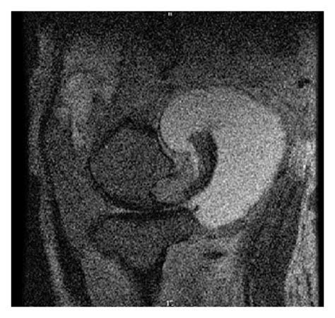 Secondary Knee Osteoarthritis Due To Neurofibromatosis Type 1 Treated