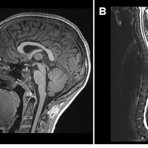 A A Large Pineal Cyst With Compressed Quadrigeminal Plate And