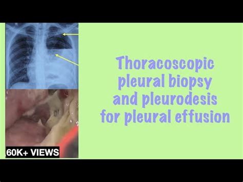 Thoracoscopic Vats Pleural Biopsy And Pleurodesis For Pleural