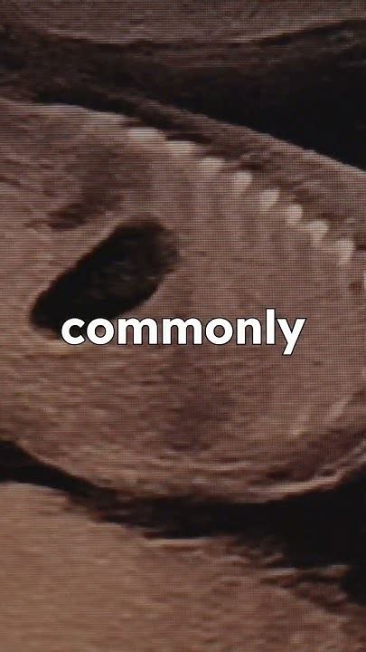 👶fetal Sex Determination👶 Youtube