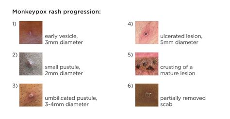 Hand Foot Mouth Disease Vs Monkeypox At Linda Rice Blog