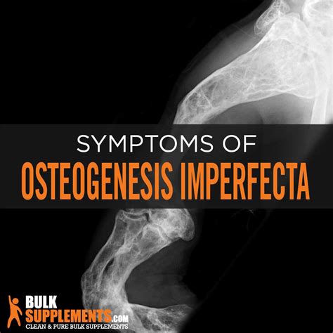 Osteogenesis Imperfecta Oi Symptoms Causes And Treatment