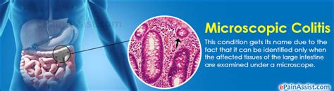 Microscopic Colitis Treatment Diet Symptoms Diagnosis Causes