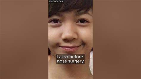 Lisa Before And After Plastic Surgery Kpop Blackpink Lalisa Lisa