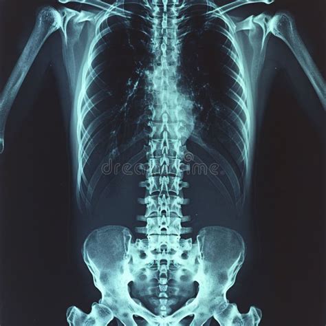 Posterior Ribs Anatomy Xray