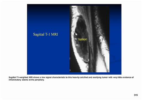 Soft Tissue Osteosarcoma An Atlas Of Musculoskeletal Oncology