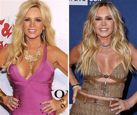 These 20 Celebs Had Their Breast Implants Removed—before And After