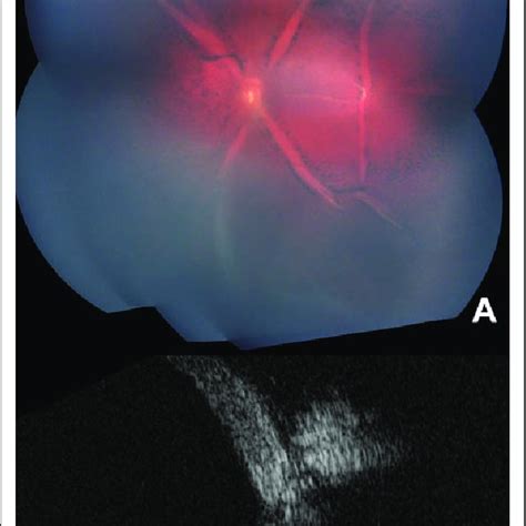 A Diffuse Choroidal Hemangioma Of The Left Eye B Choroidal Download Scientific Diagram