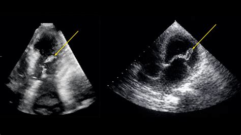 Rupture Of The Papillary Papilliform Muscle Post Infarction Symptoms