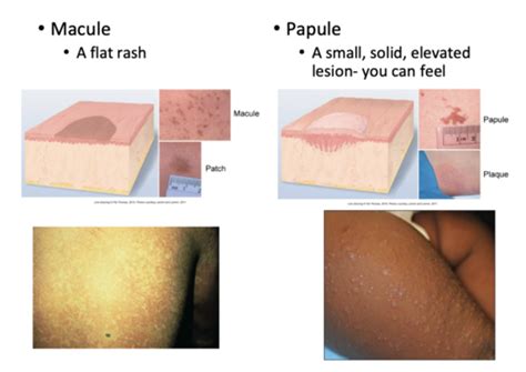 Dermatology Flashcards Quizlet