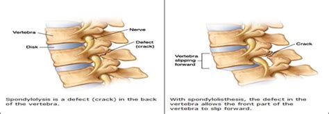 Spondylolisthesis Ayurveda Treatment Nagarjuna Ayurveda