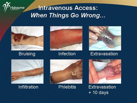 Iv Infiltration Blanching