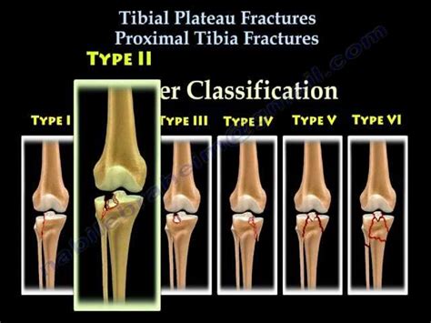 Proximal Tibia Anatomy