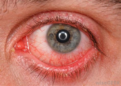 Qanda Monday Will High Blood Pressure Damage My Vision