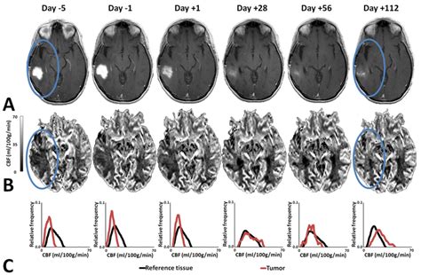 Increased Perfusion Representative Example Of A Patient With Perfusion